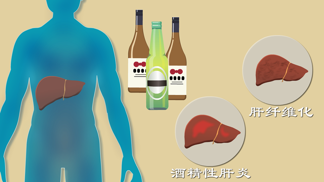 酒精肝 酒精肝的症状 什么是酒精肝 科普视频 在线问诊 深读视频 深度